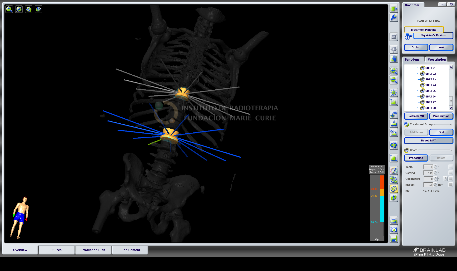 Instituto Zunino - Radiocirugia Novalis TX. Exatrac. Gating respiratorio